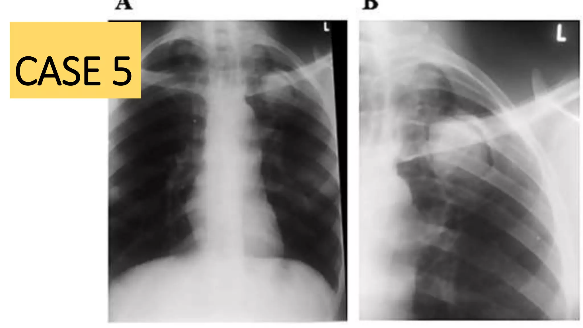 Chest Mocks Radiology-Interesting Cases. | PPTX | Lung and Respiratory ...