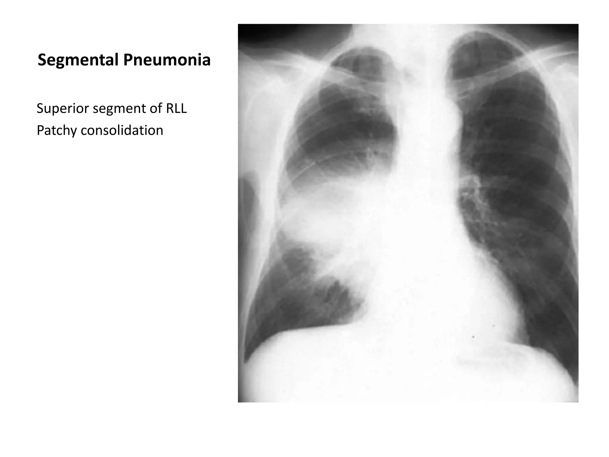 Chest x - ray | PPTX