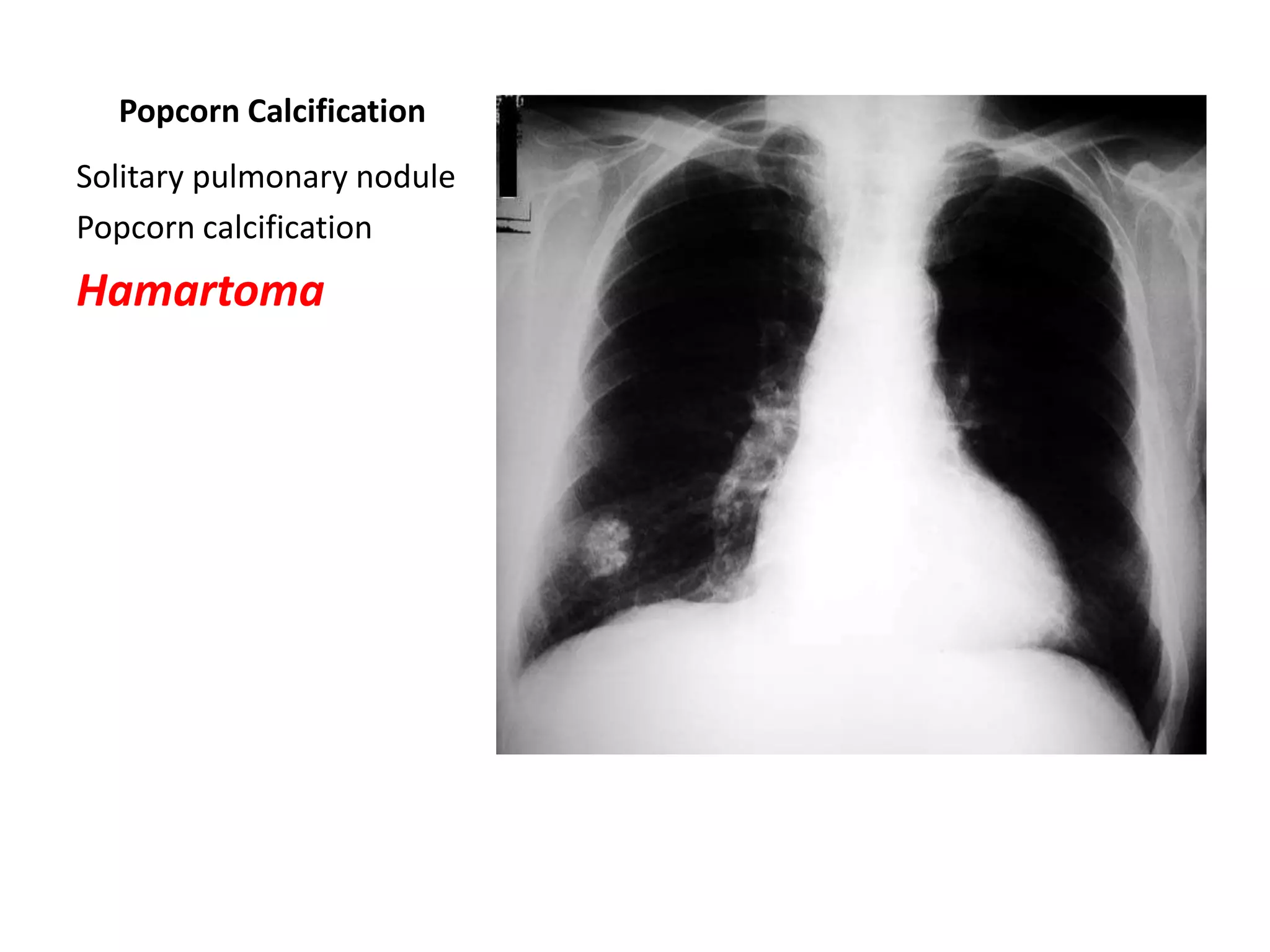 Chest x - ray | PPTX
