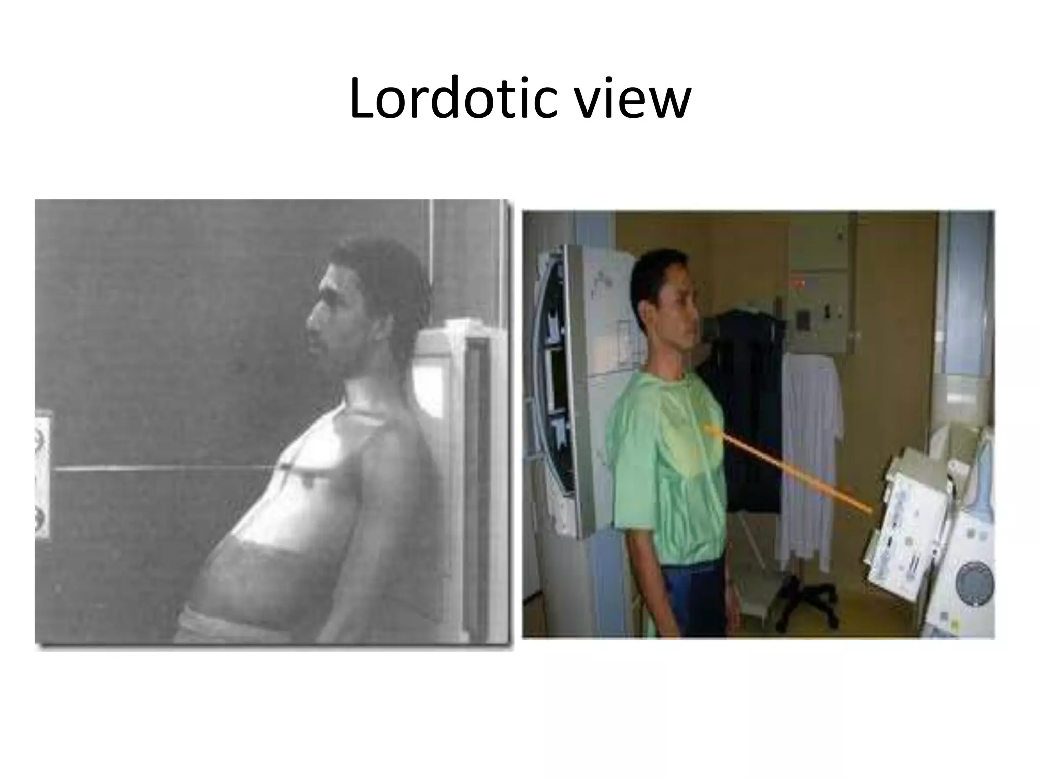 Chest x - ray | PPTX