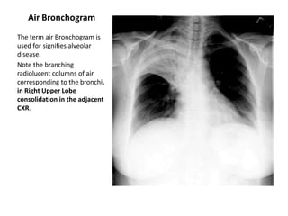Chest x - ray | PPTX | Lung and Respiratory Health | Diseases and ...