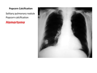 Chest x - ray | PPTX | Lung and Respiratory Health | Diseases and ...