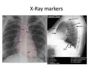 Chest x - ray | PPTX | Lung and Respiratory Health | Diseases and ...
