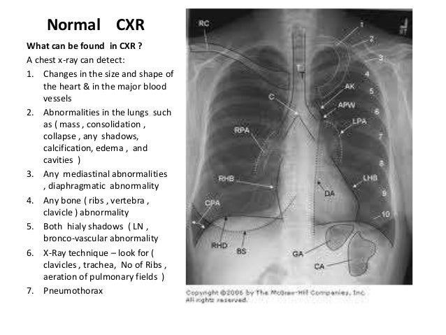 Chest x - ray