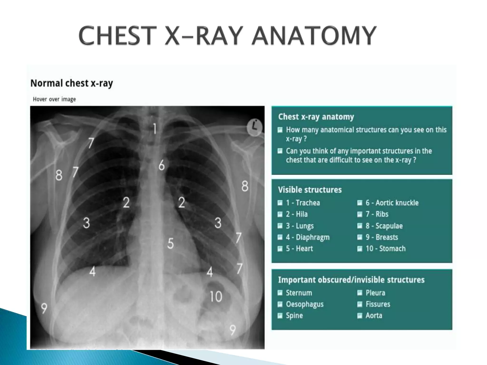 Chest x-ray.zp162335 | PPT