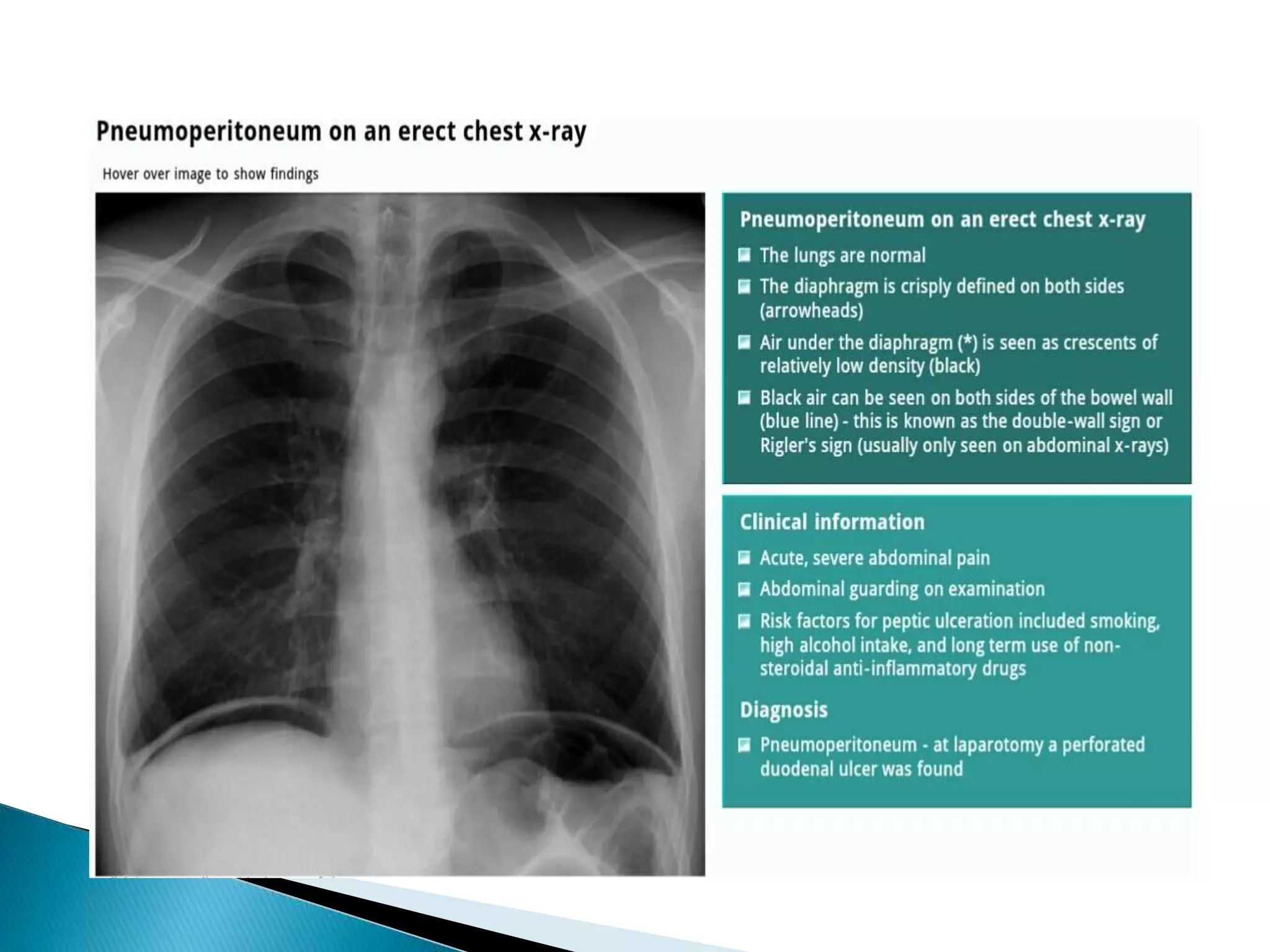 chest-x-ray.zp162335.ppt