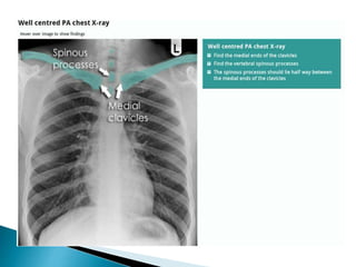 chest-x-ray.zp162335.ppt