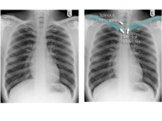 Chest-X-ray-Quality.presentations for med | PPTX