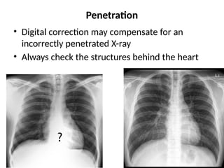 Chest-X-ray-Quality.presentations for med | PPTX