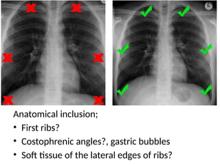 Chest-X-ray-Quality.presentations for med | PPT