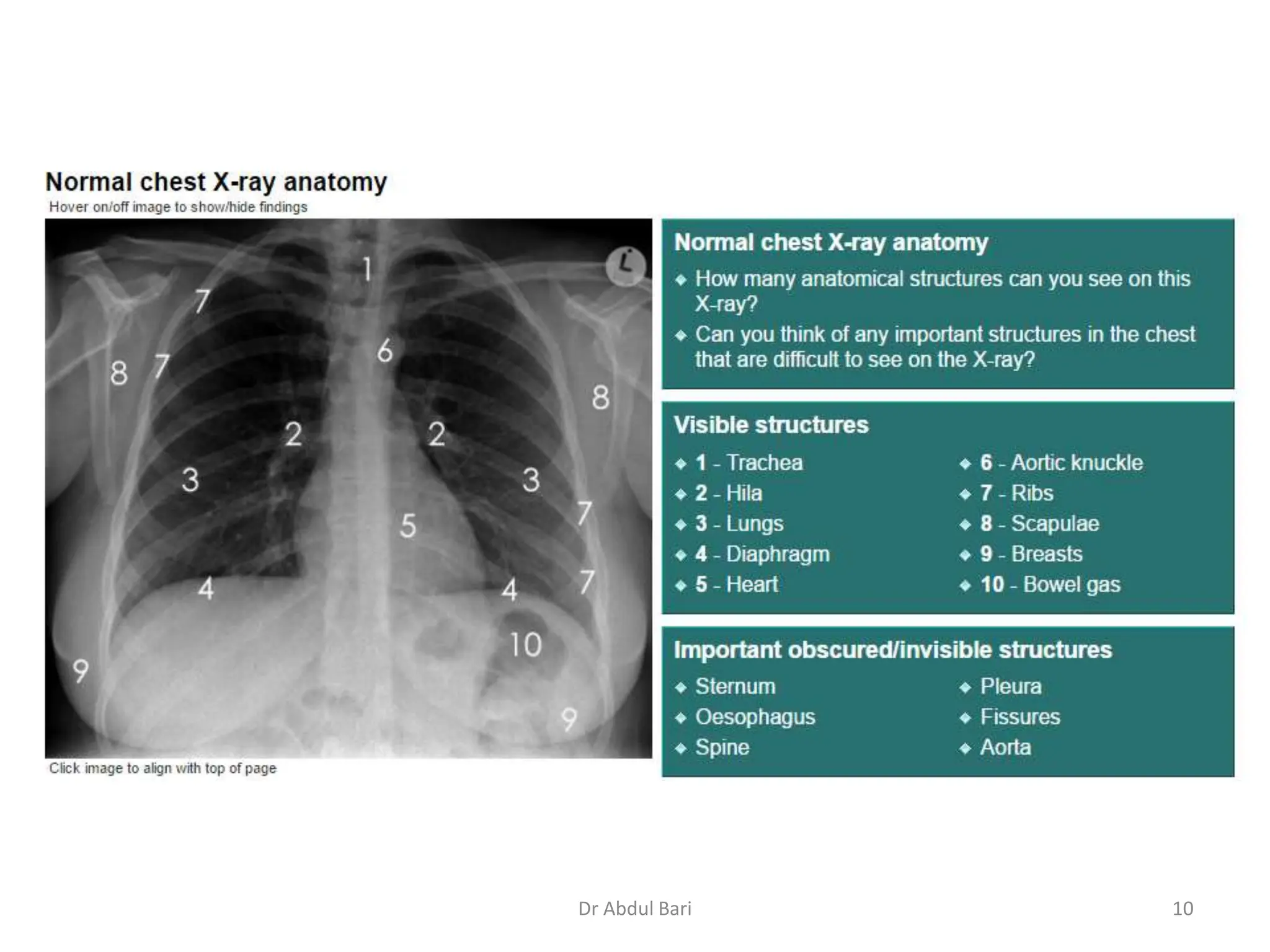 chest-x-ray-teaching-tutorial.pptx