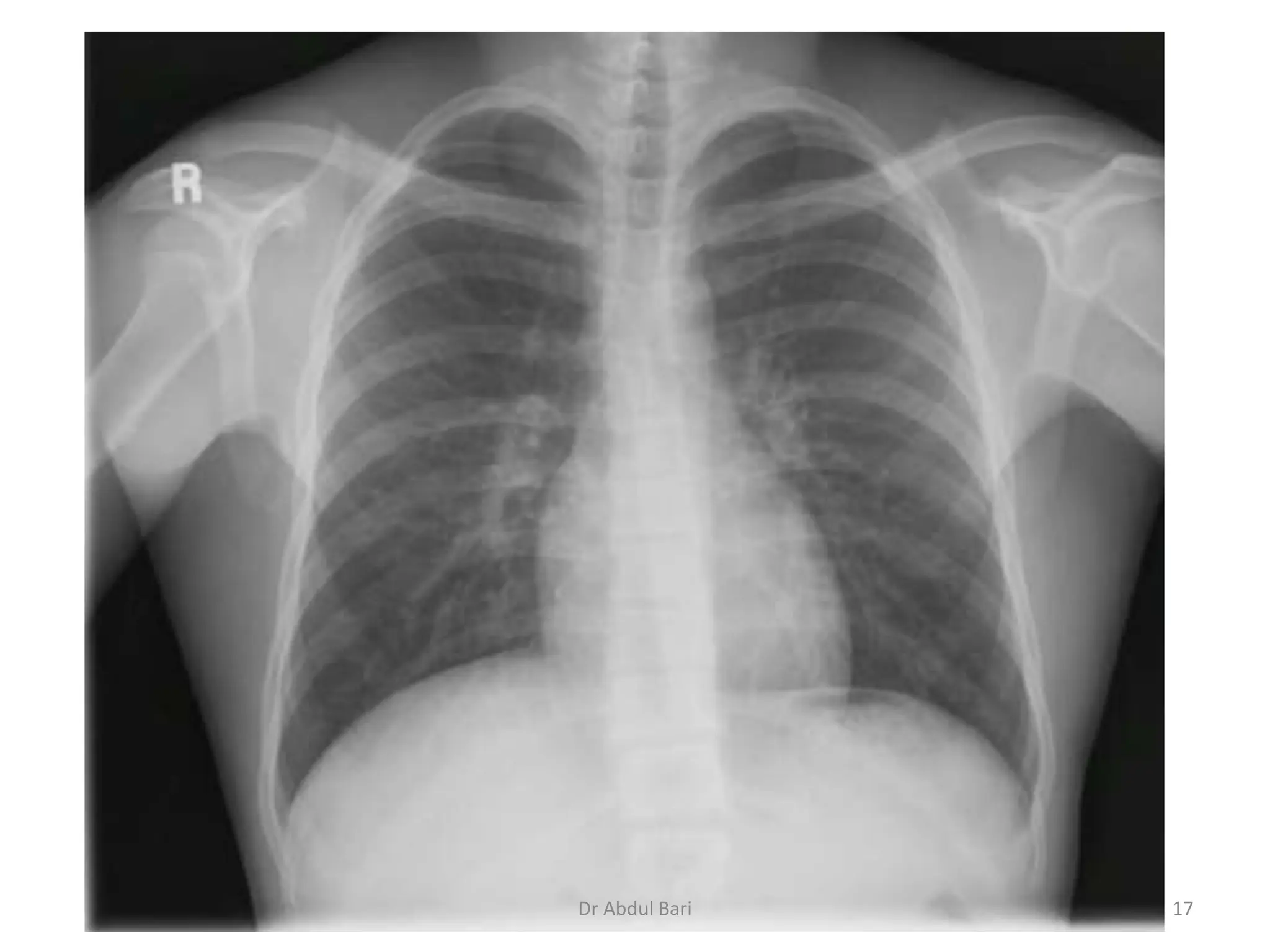 chest-x-ray-teaching-tutorial.pptx