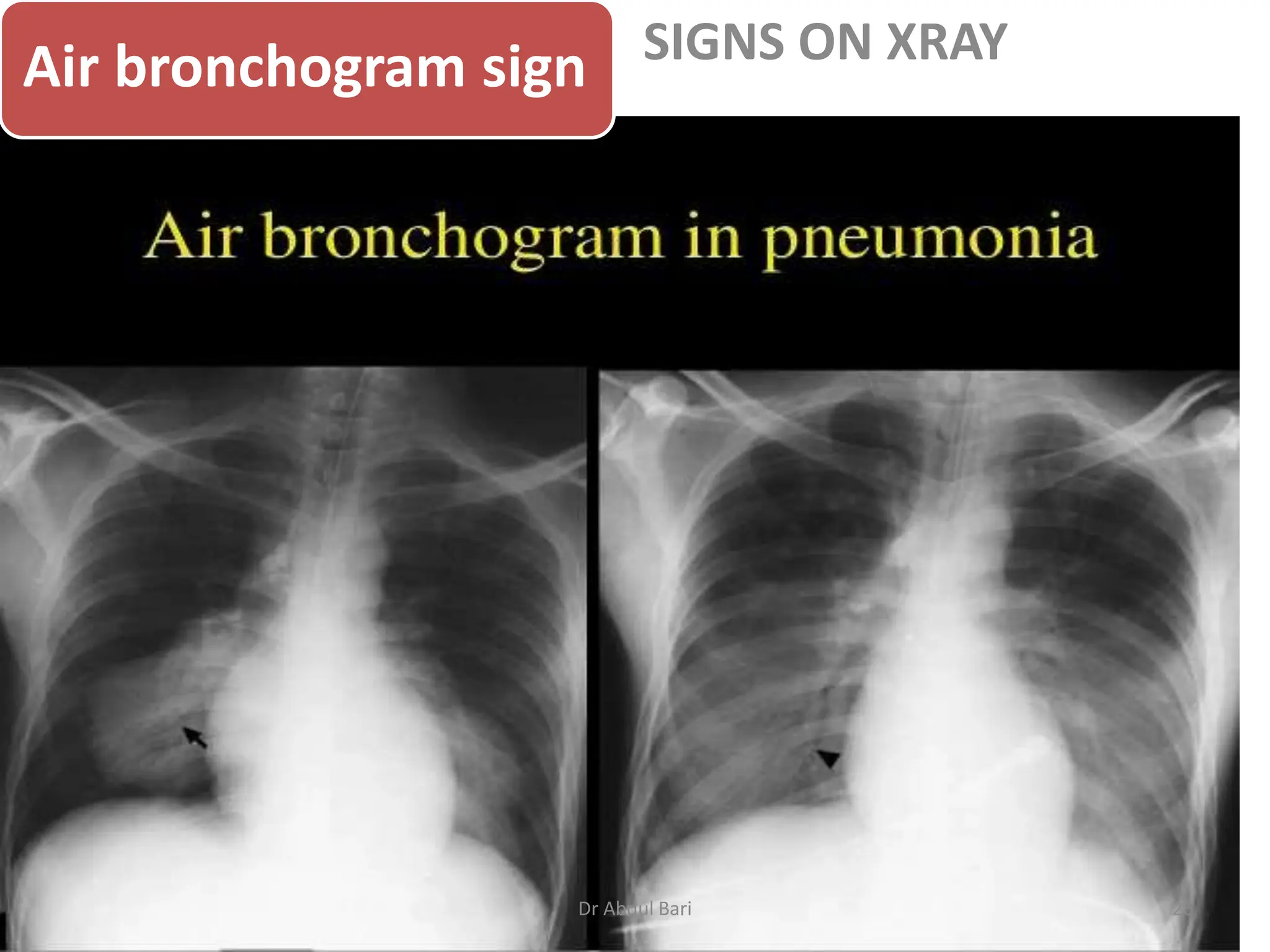 chest-x-ray-teaching-tutorial.pptx