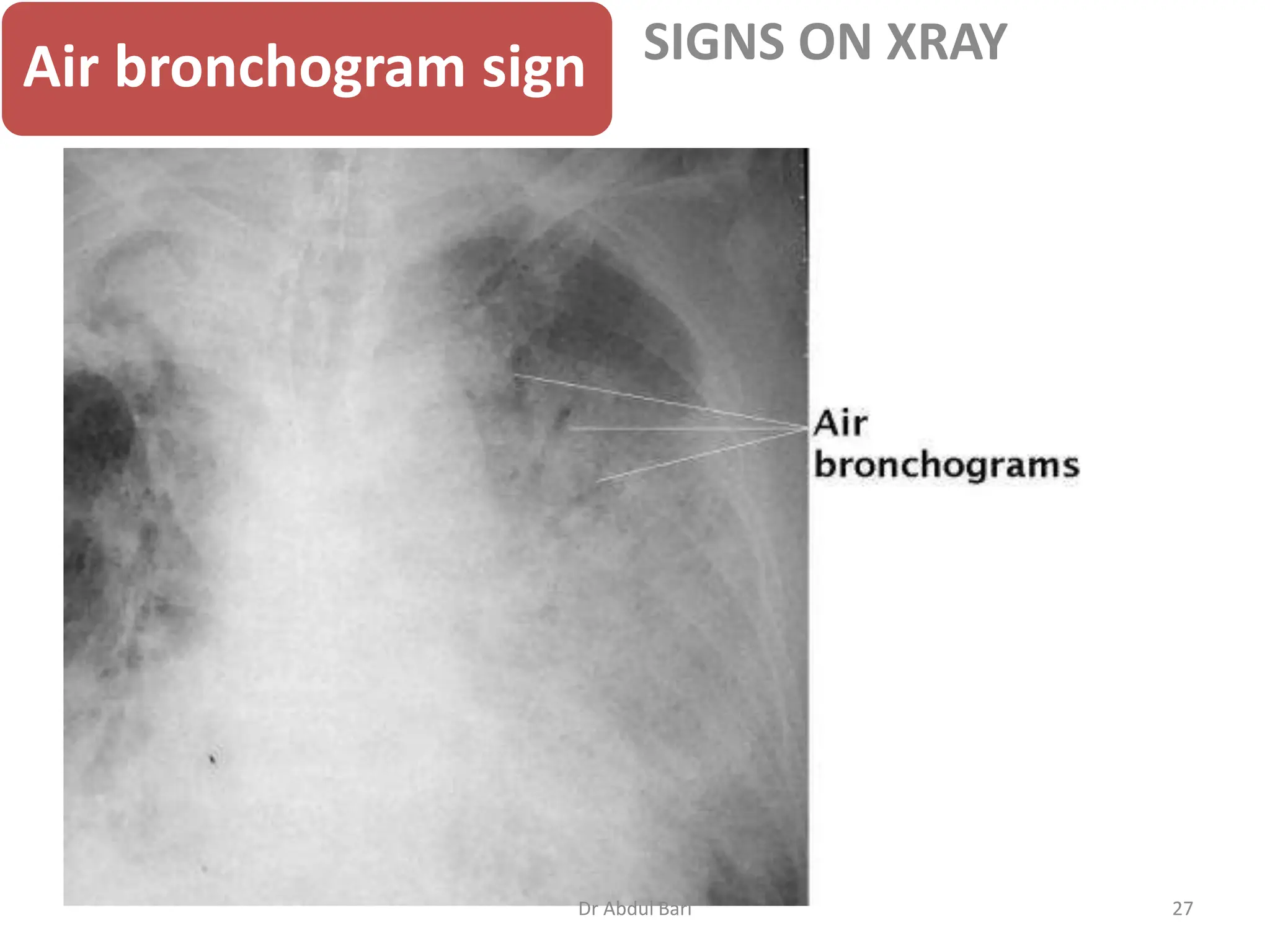 chest-x-ray-teaching-tutorial.pptx