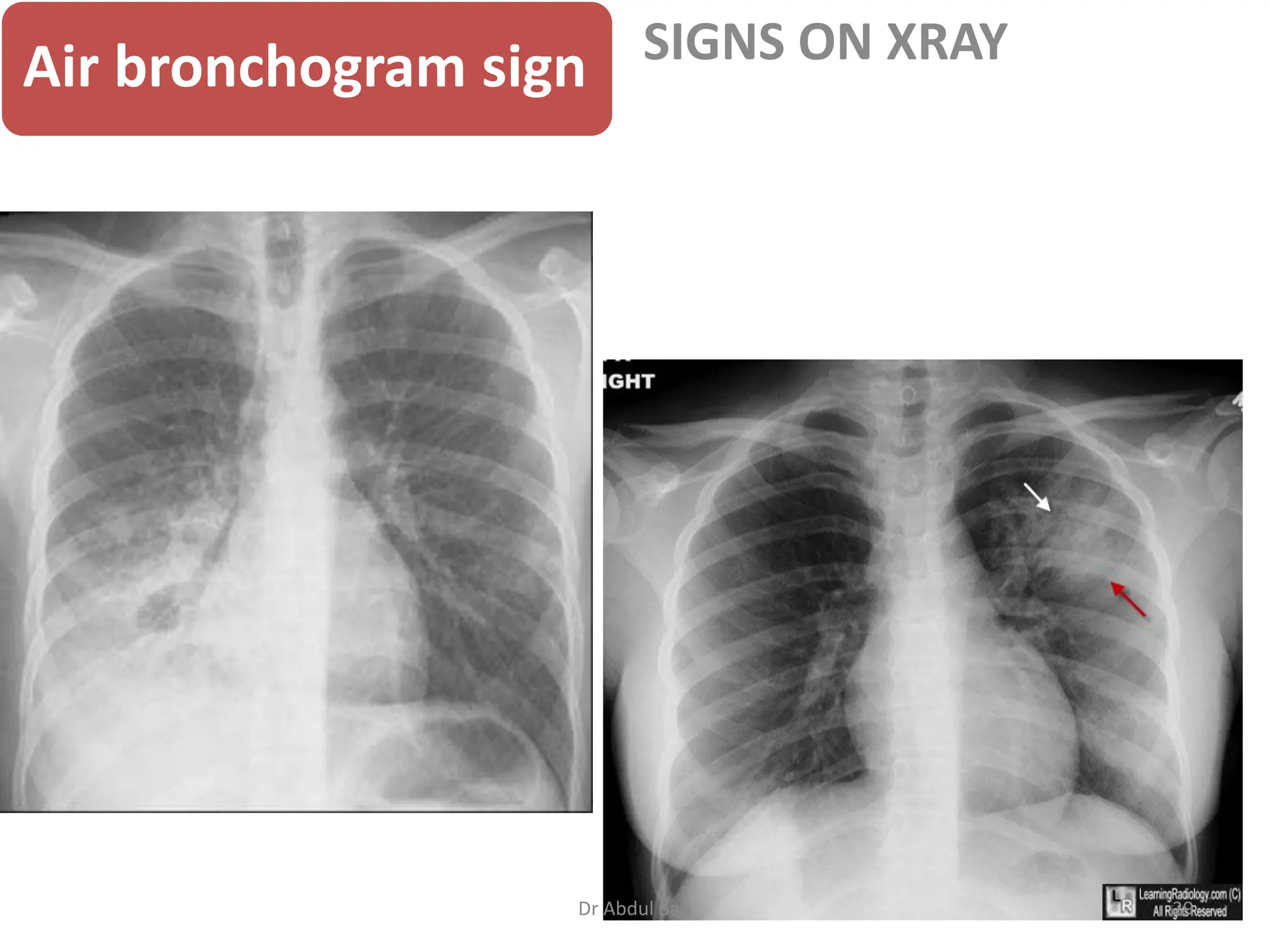 chest-x-ray-teaching-tutorial.pptx