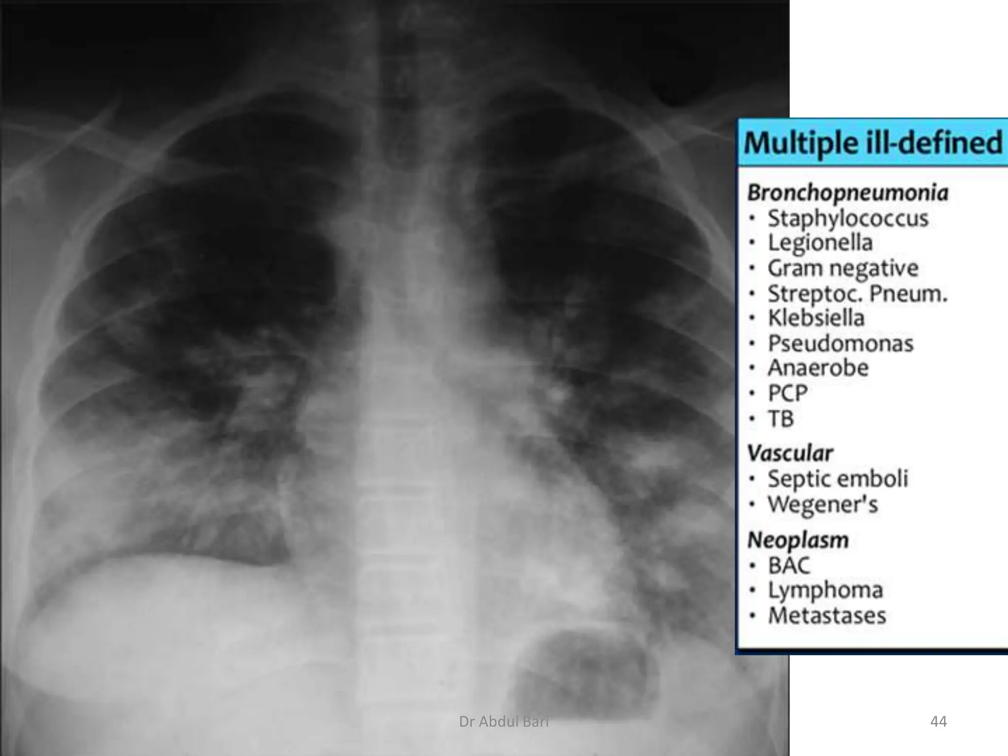 chest-x-ray-teaching-tutorial.pptx