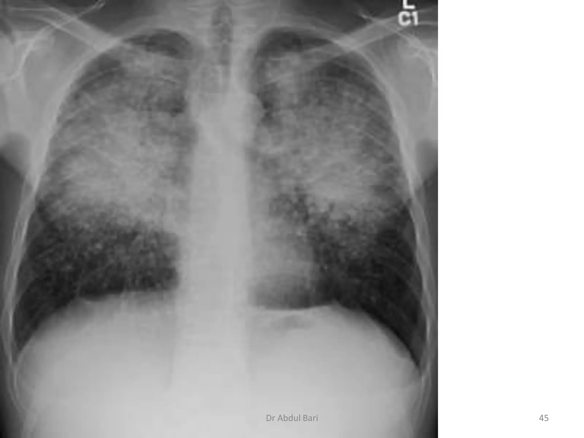 chest-x-ray-teaching-tutorial.pptx
