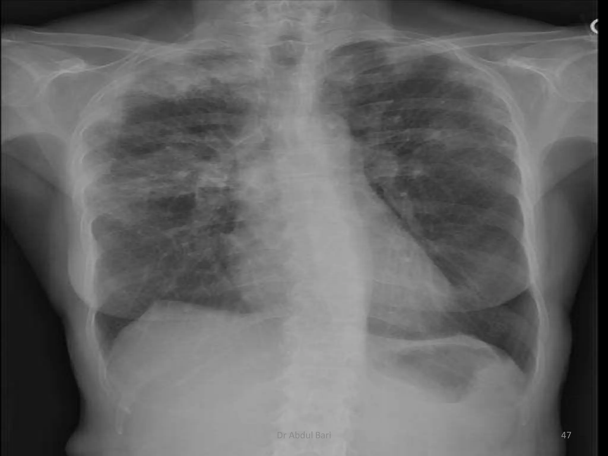 chest-x-ray-teaching-tutorial.pptx