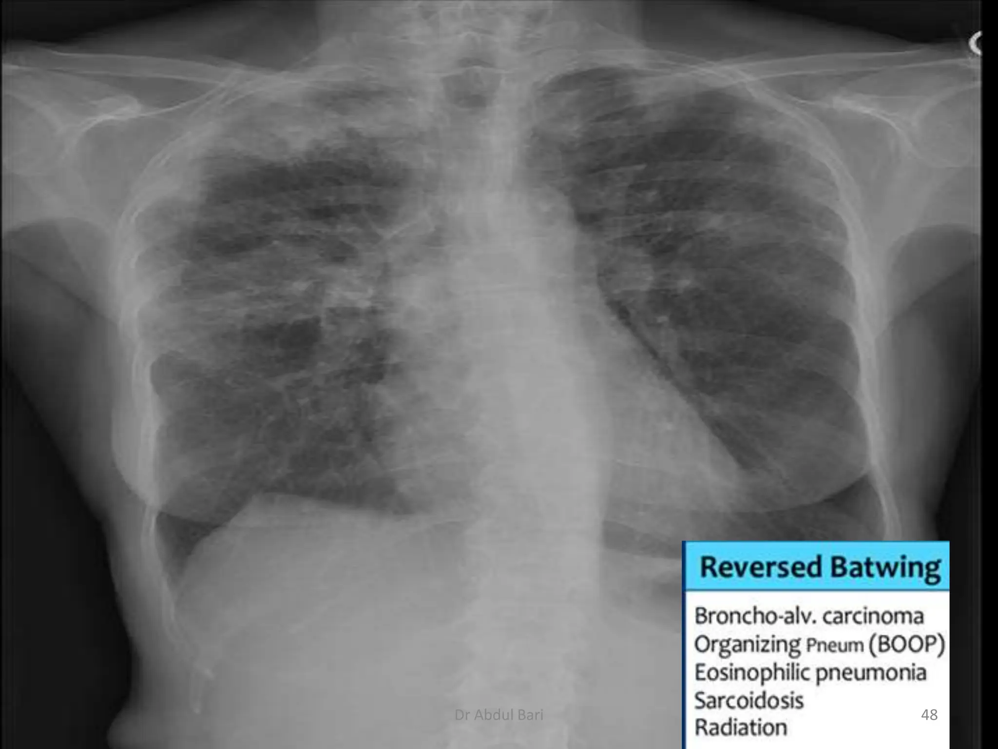 chest-x-ray-teaching-tutorial.pptx
