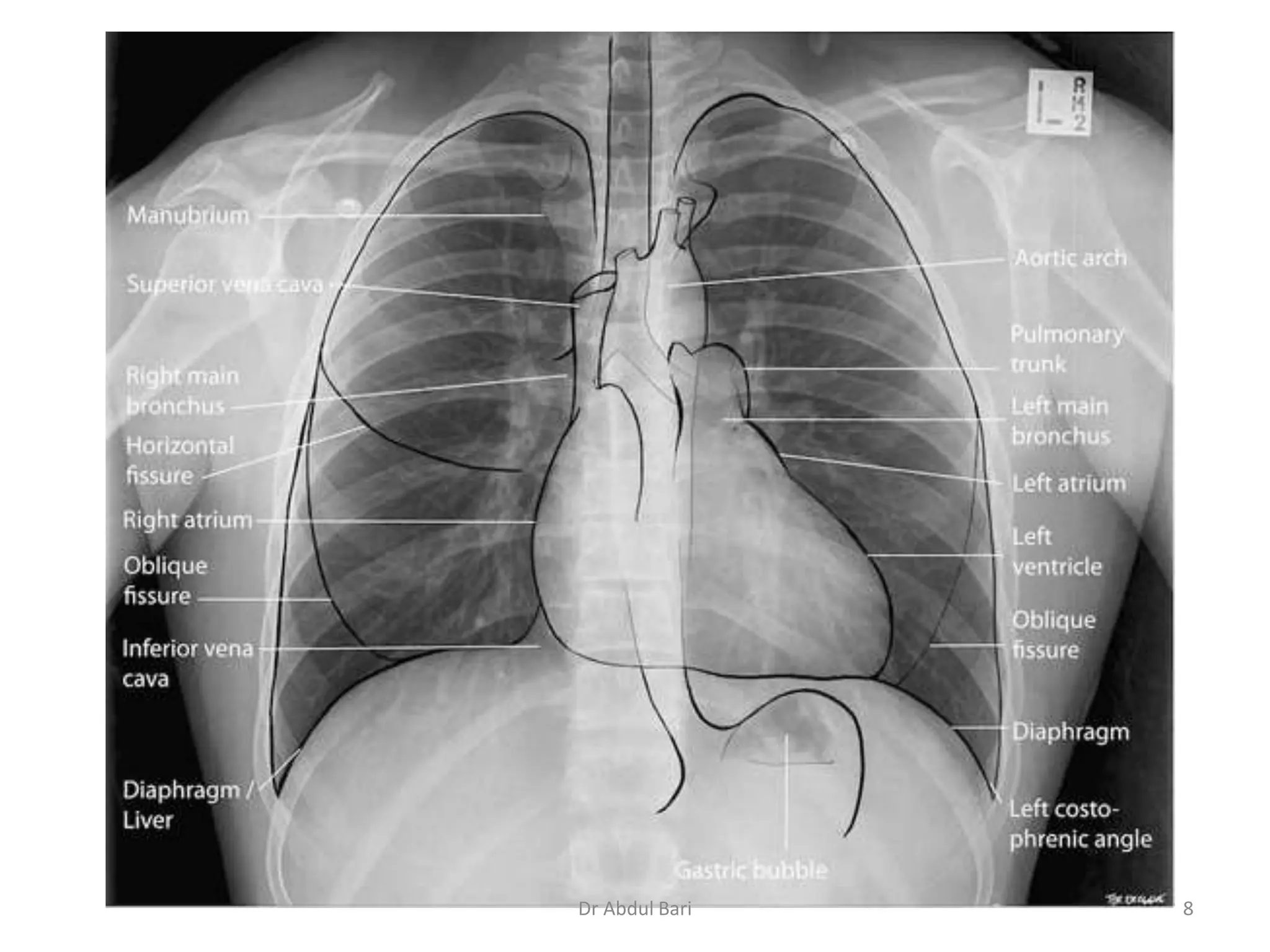 chest-x-ray-teaching-tutorial.pptx