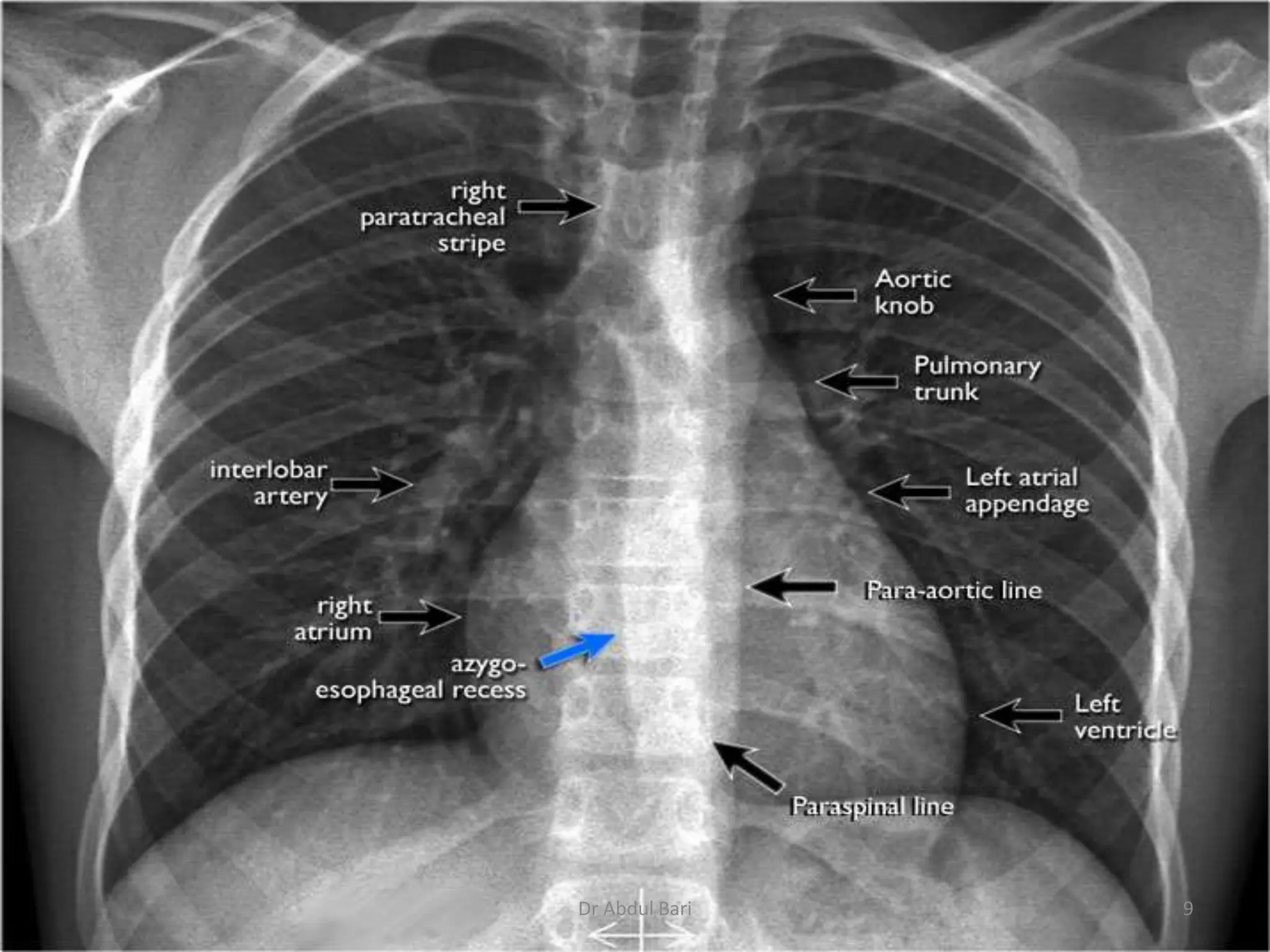 chest-x-ray-teaching-tutorial.pptx