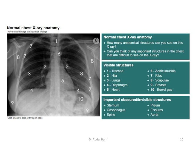 chest-x-ray-teaching-tutorial.pptx