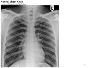 chest-x-ray-teaching-tutorial.pptx