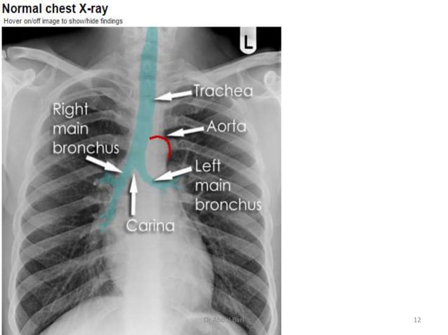 chest-x-ray-teaching-tutorial.pptx