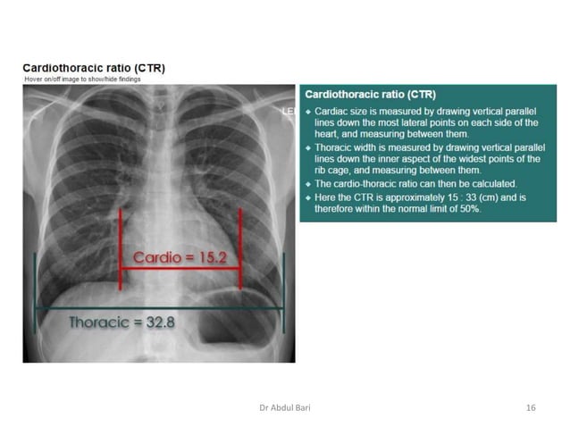 chest-x-ray-teaching-tutorial.pptx