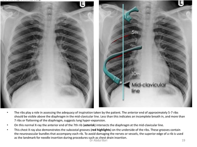 chest-x-ray-teaching-tutorial.pptx