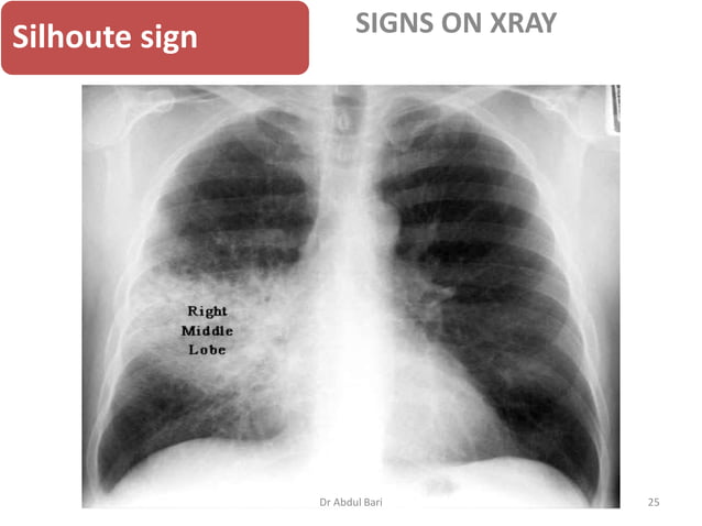 chest-x-ray-teaching-tutorial.pptx