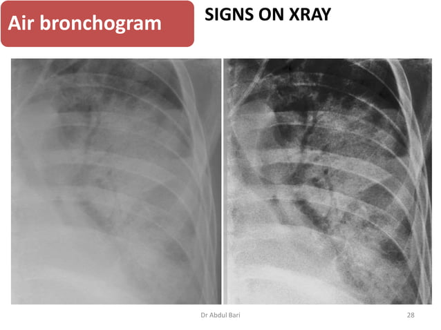 chest-x-ray-teaching-tutorial.pptx