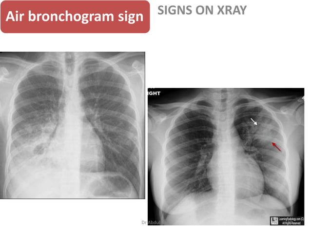 chest-x-ray-teaching-tutorial.pptx