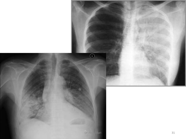chest-x-ray-teaching-tutorial.pptx