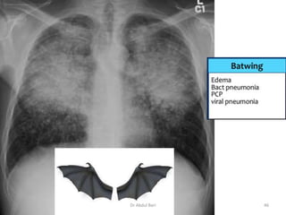chest-x-ray-teaching-tutorial.pptx