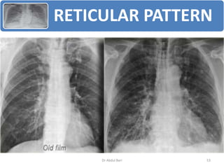 chest-x-ray-teaching-tutorial.pptx
