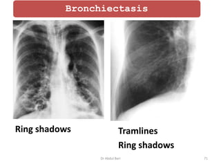 chest-x-ray-teaching-tutorial.pptx