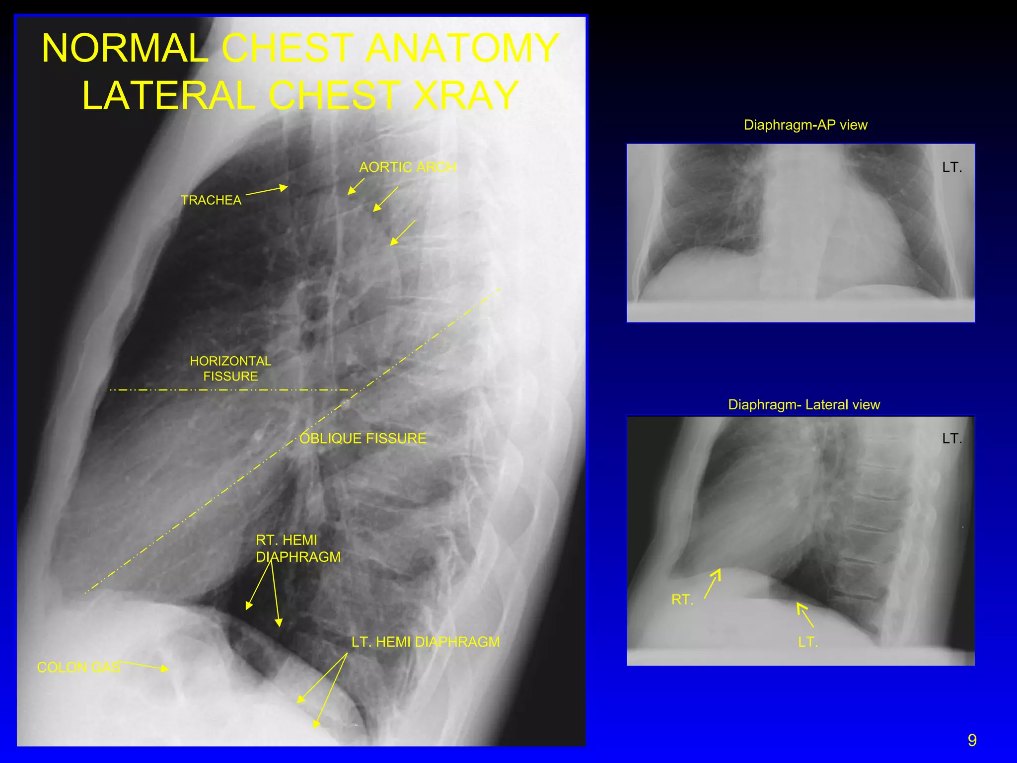 Chest Xray | PPT