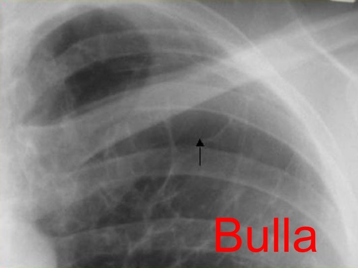 Chest Xray