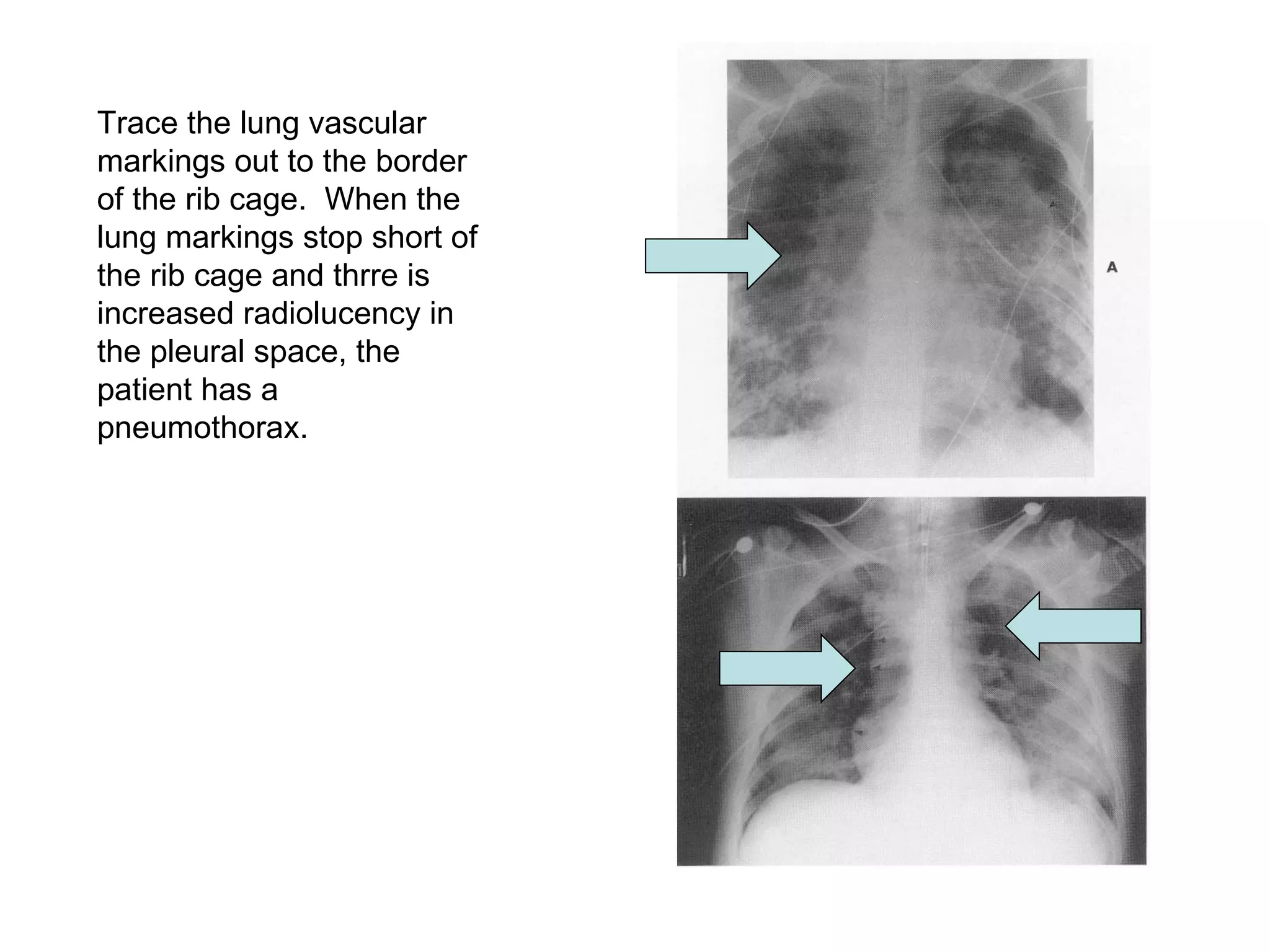 Chest X Ray Interpretation | PPT