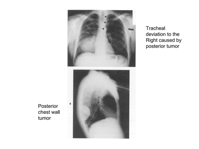 Chest X Ray Interpretation | PPT