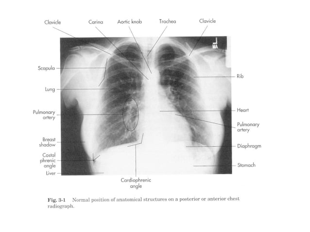 Chest X Ray Interpretation | PPT | Lung and Respiratory Health ...