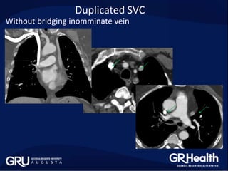 Congenital venous anomalies of the Chest | PPTX