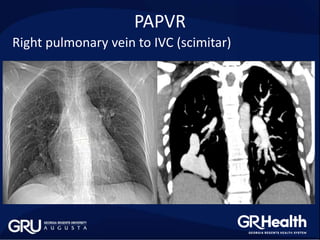 Congenital venous anomalies of the Chest | PPTX