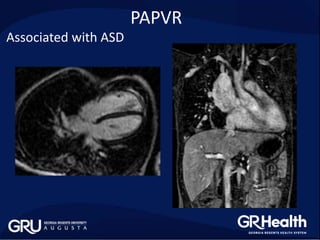 Congenital venous anomalies of the Chest | PPTX