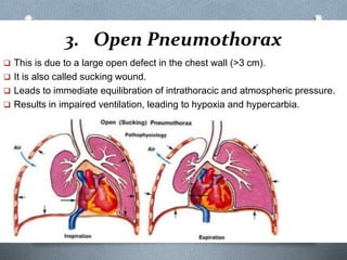 Chest 12. Chest Trauma.pptx