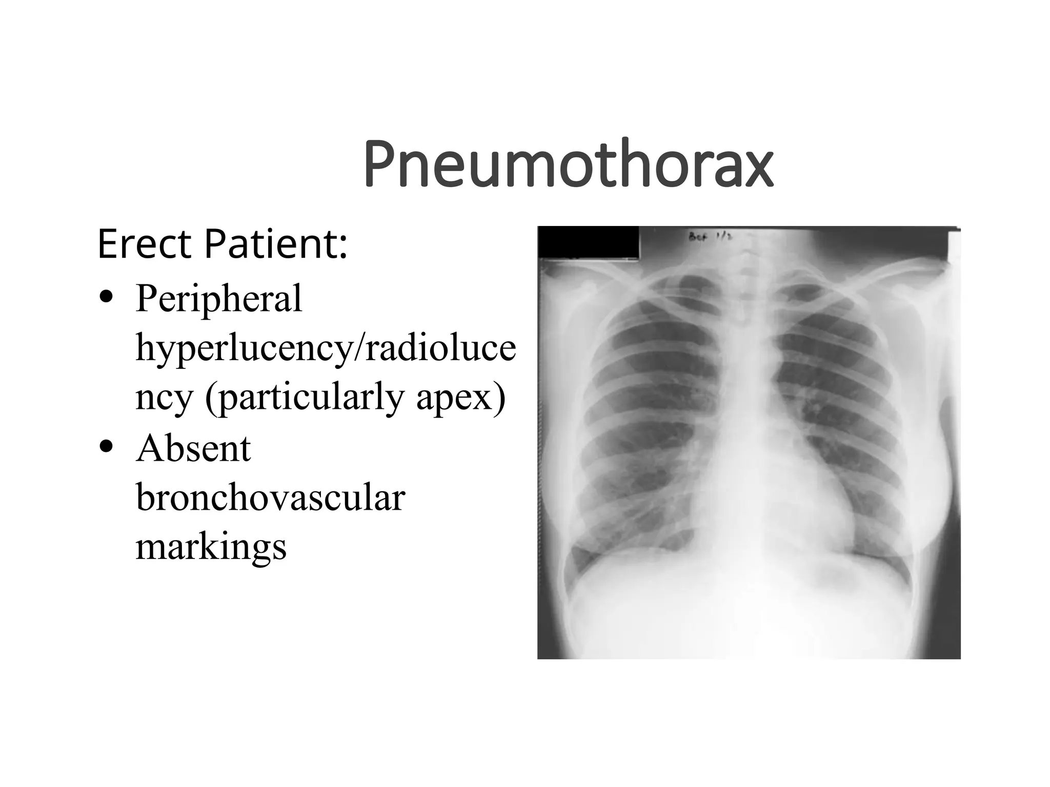 CHEST interpretiation with example (2).pptx