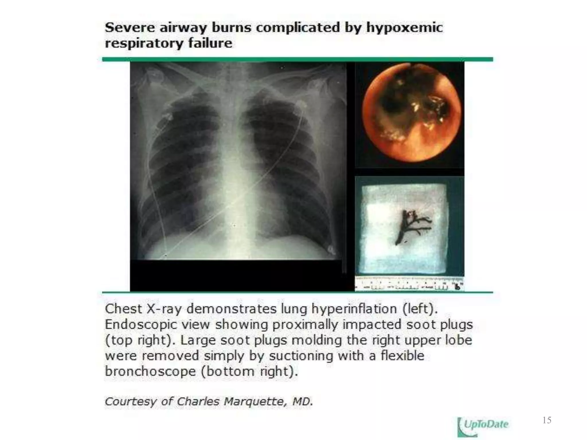 Management Of Foreign Body Aspiration (FBA) And Central Airway ...