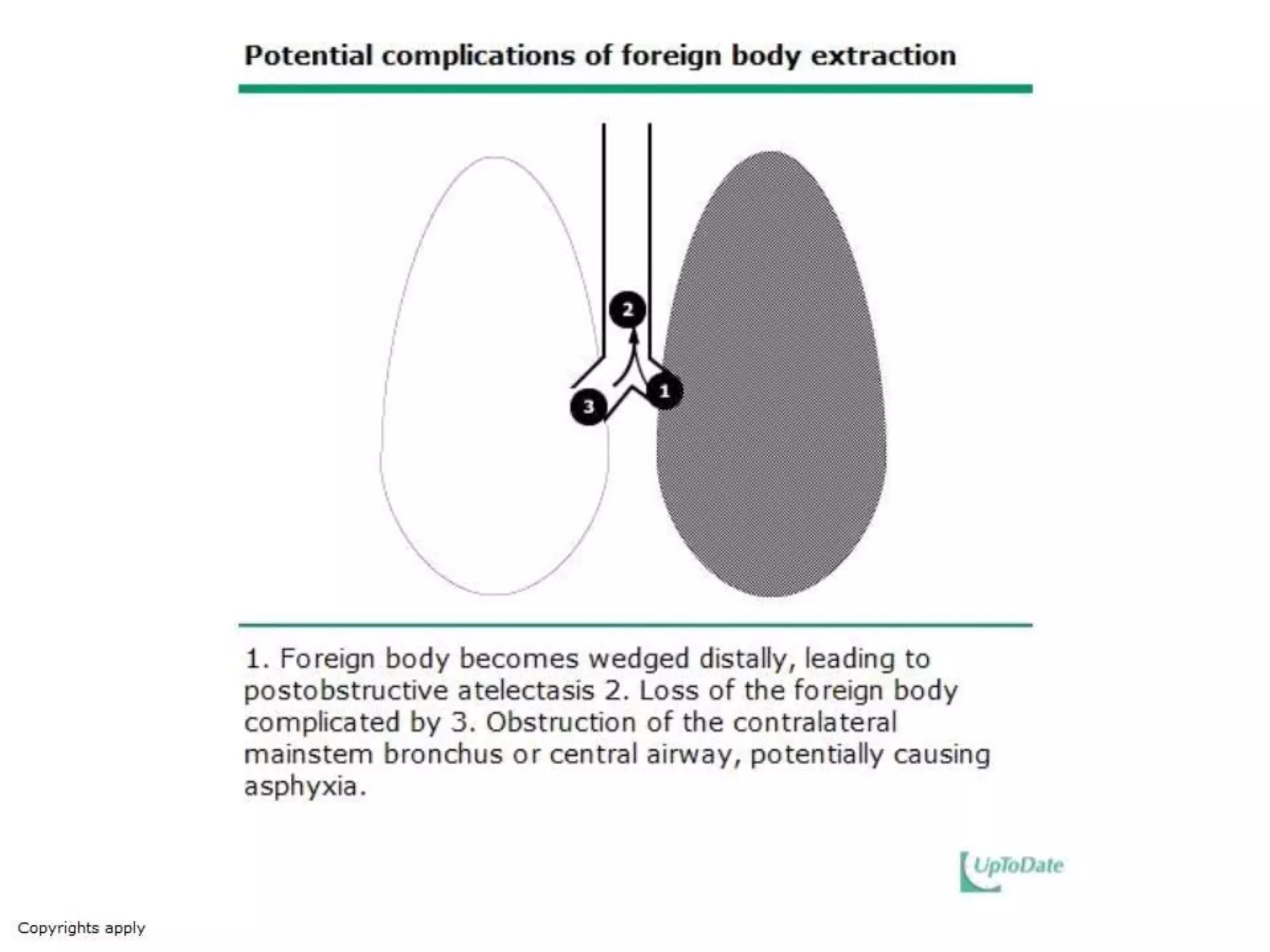 Management Of Foreign Body Aspiration (FBA) And Central Airway ...