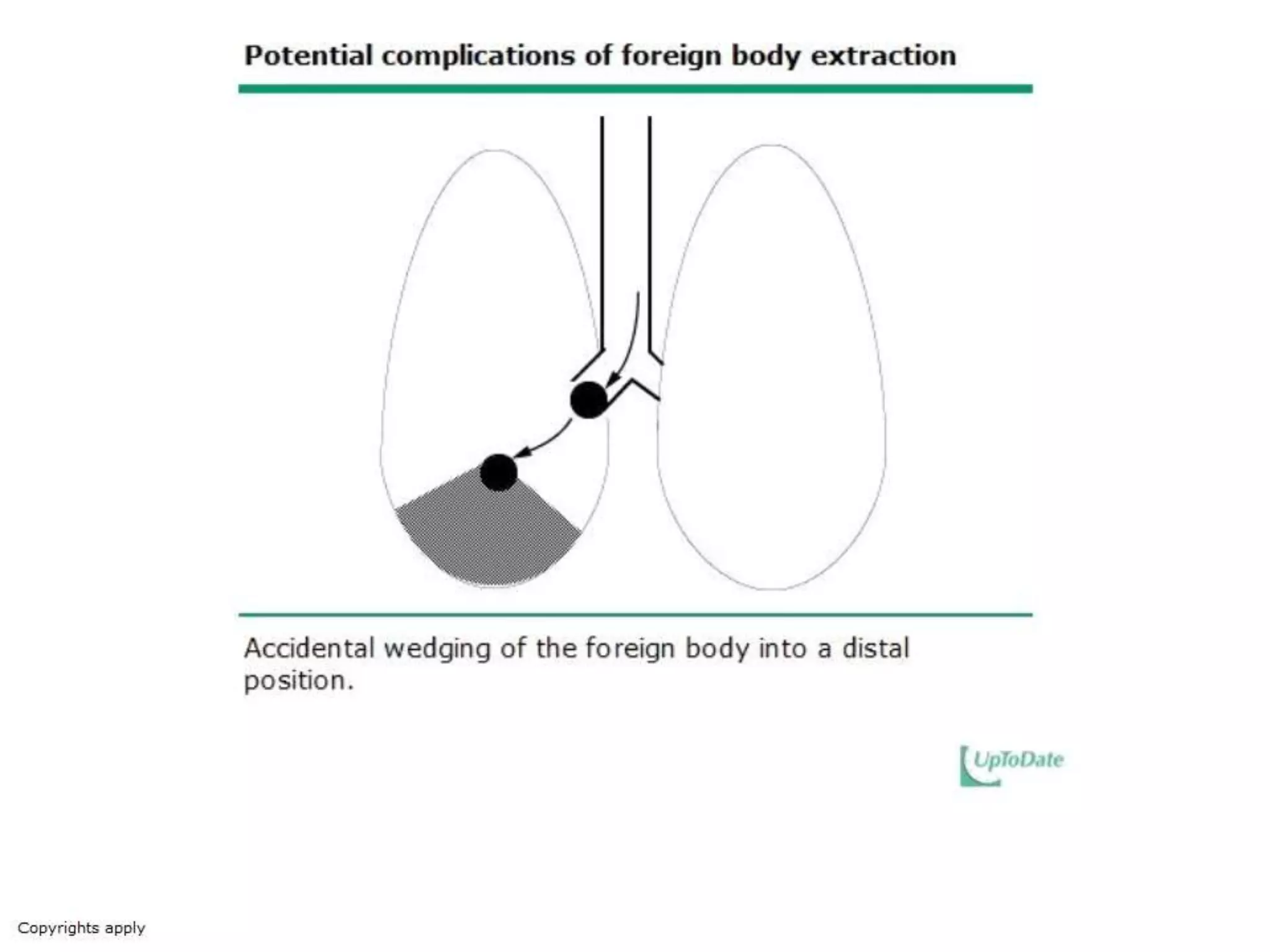 Management Of Foreign Body Aspiration (FBA) And Central Airway ...
